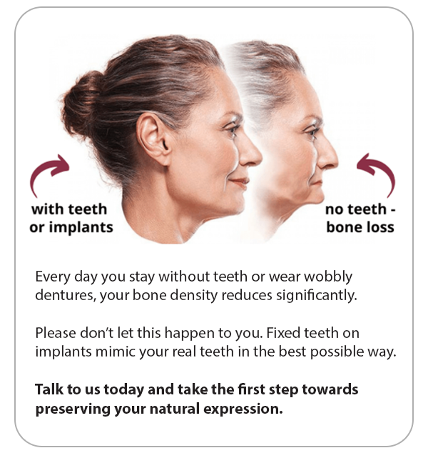 Caring for Dental Implants - Essential Tips - Dentaprime UK