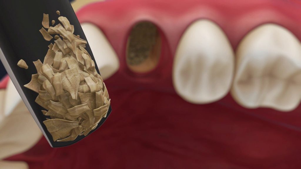 Tried-And-Tested, Safe and Often Necessary: Bone Augmentation ...